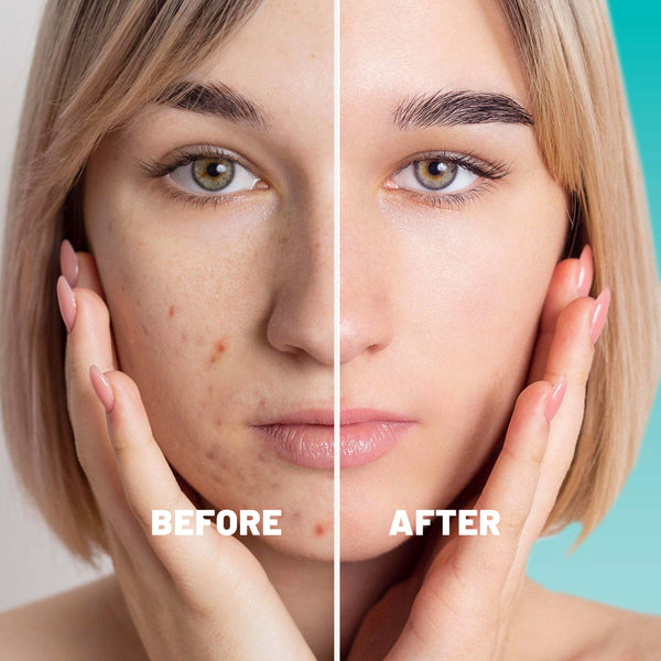 Microdart Patches Targeted Blemish & Skin Support with Hyaluronic Acid ...